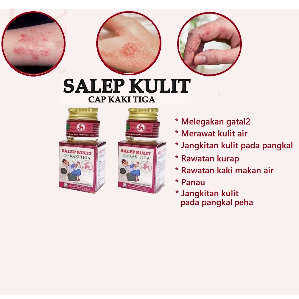 salap Cap kaki, tiga / Kurap , Panau , Kudis jangkitan kulat | Shopee ...