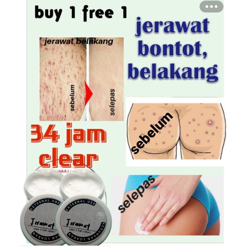 krim putih kulit,krim jerawat bontot,jerawat punggung,jerawat belakang ...