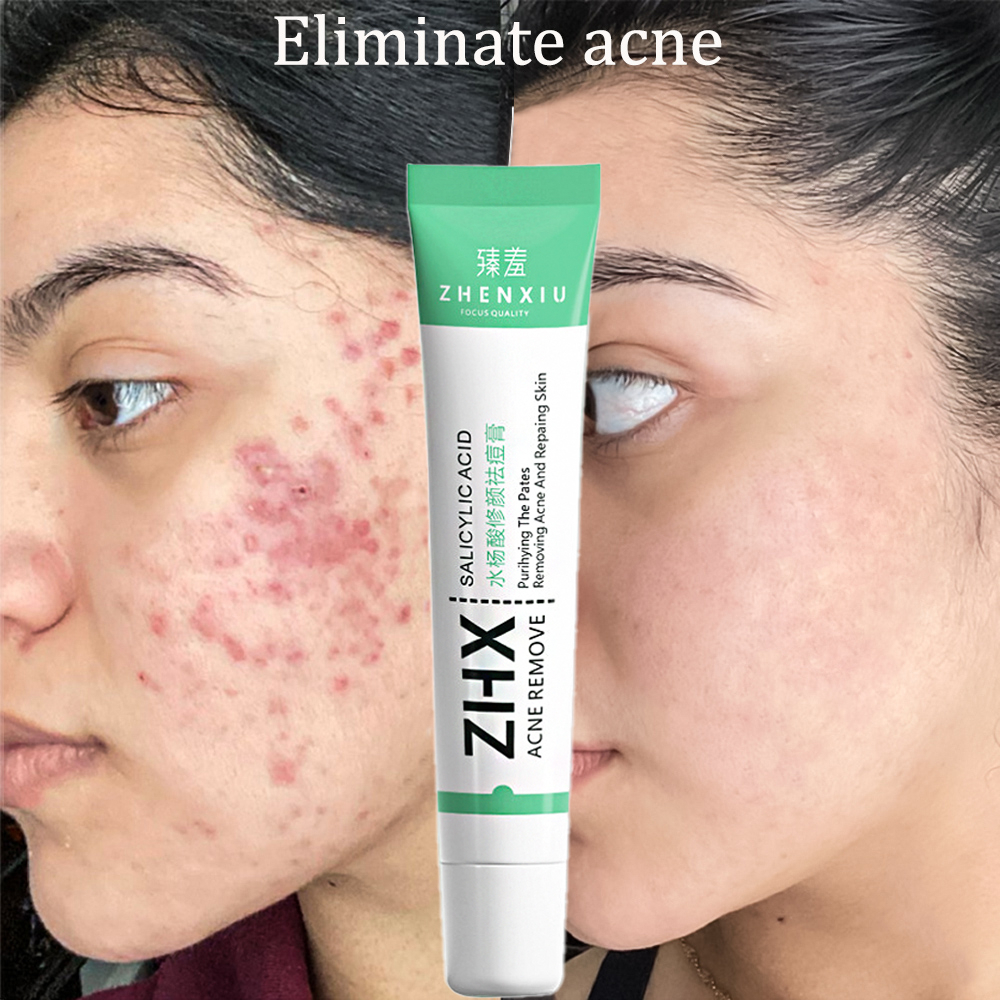 krim ubat jeragat hilangkan parut jerawat acne cream acne spot ...