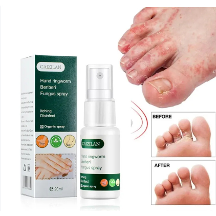 Anti Fungal Foot Spray Nails Toe Fungus Feet Spary Onychomycosis ...