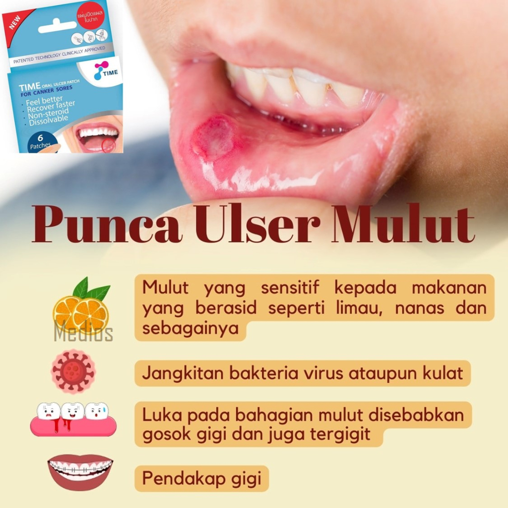 [Ship From KL] 6 Patches TIME Oral Ulcer Patch For Canker Sore (Expiry ...