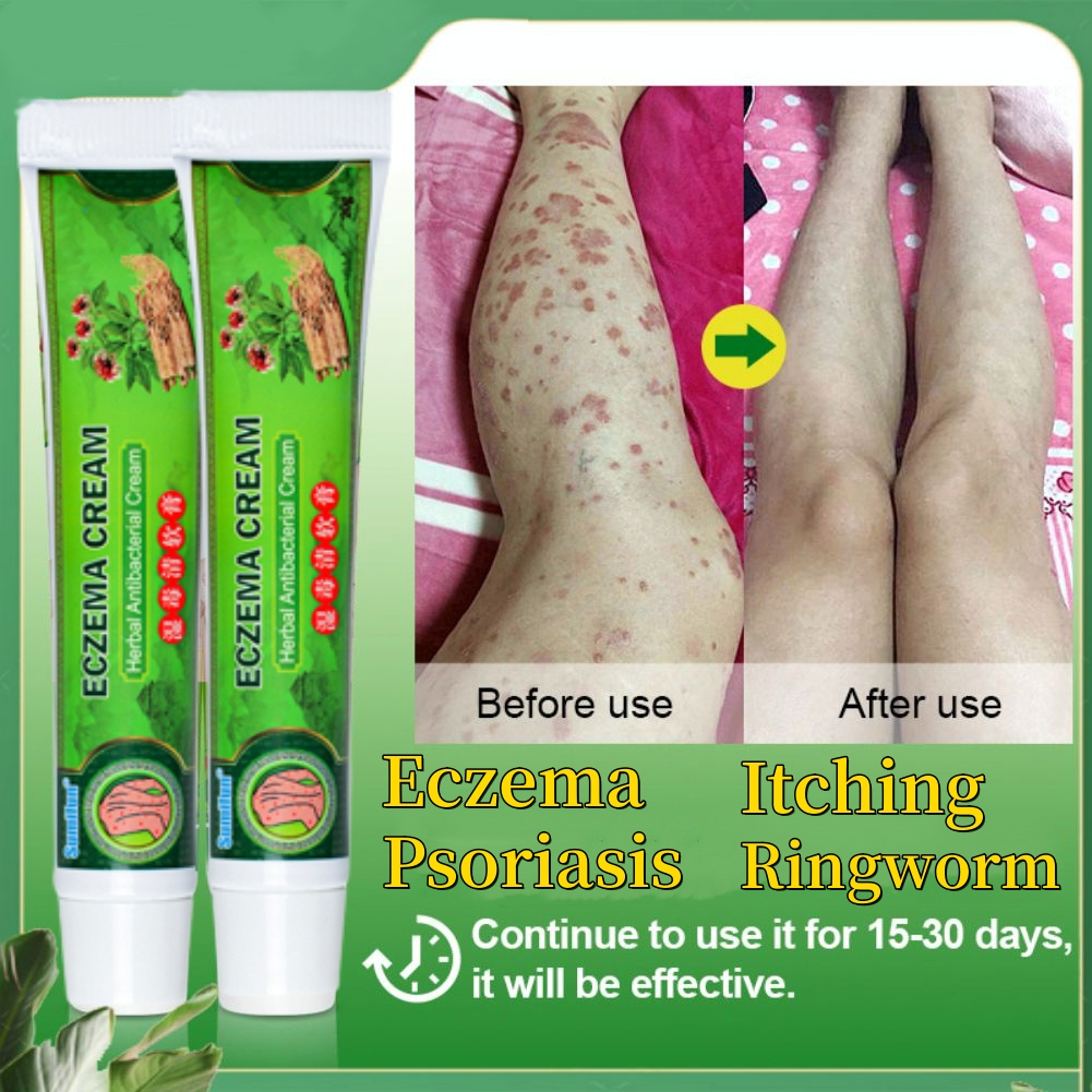 Eczema Treatment Ubat Gatal Kulit Krim Psoriasis Antifungal Cream Itchy