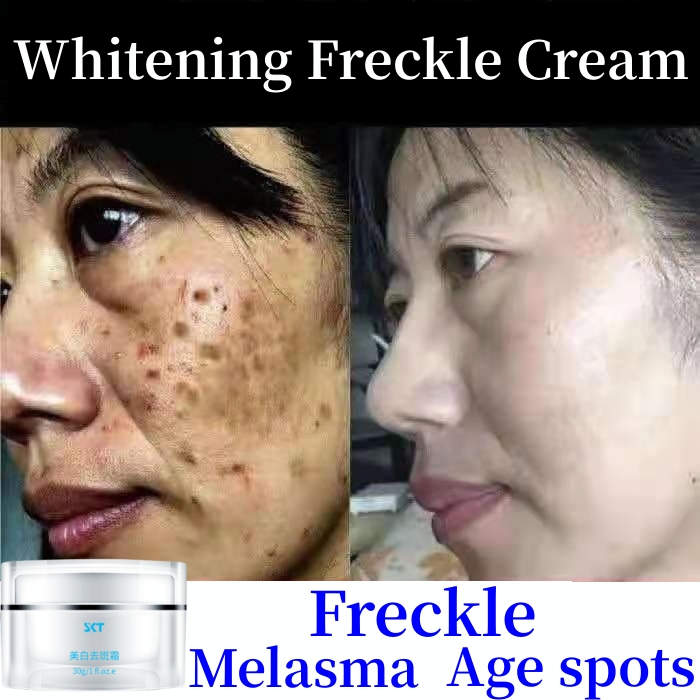 Krim jeragat krim melasma whitening freckle cream dark spot remover ...