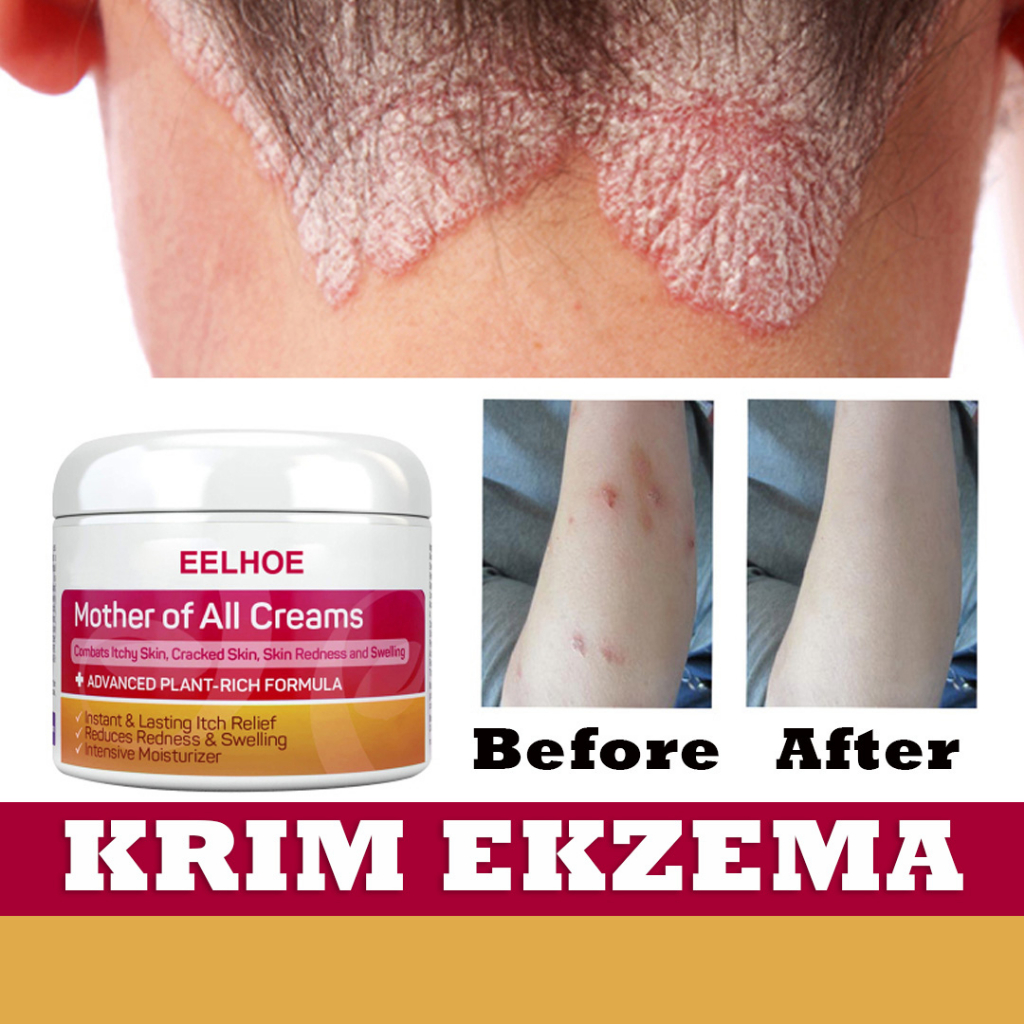 Lotion Ubat Gatal Kulit Krim Eczema Cream Herba Cina Losyen Psoriasis ...
