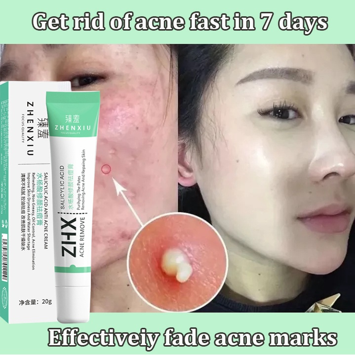 Acne Cream Krim Jerawat Acne Treatment Serum Acne Gel Pimple Scar ...