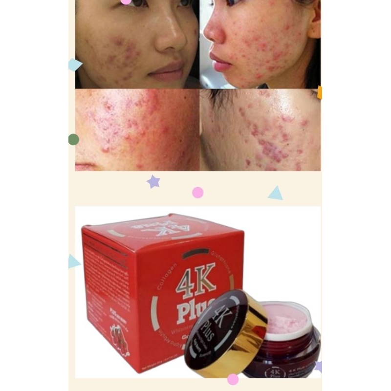 Cream 4K Plus Red 5X Acne Treatment Genuine Thailand - Super Effective ...