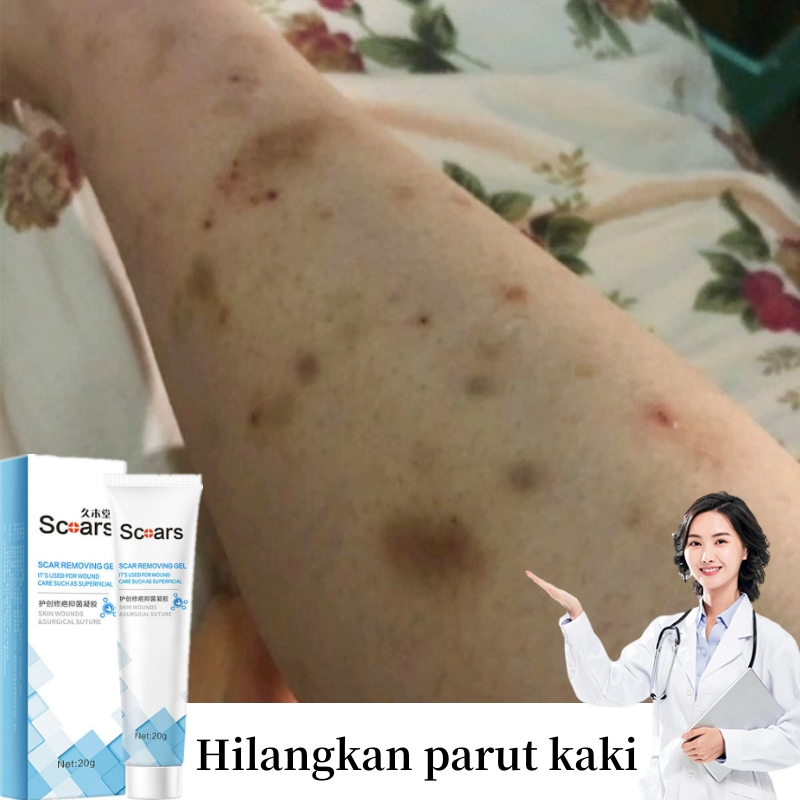 Krim hilangkan parut hitam Hilangkan Parut kaki Scar Removal Cream dark ...