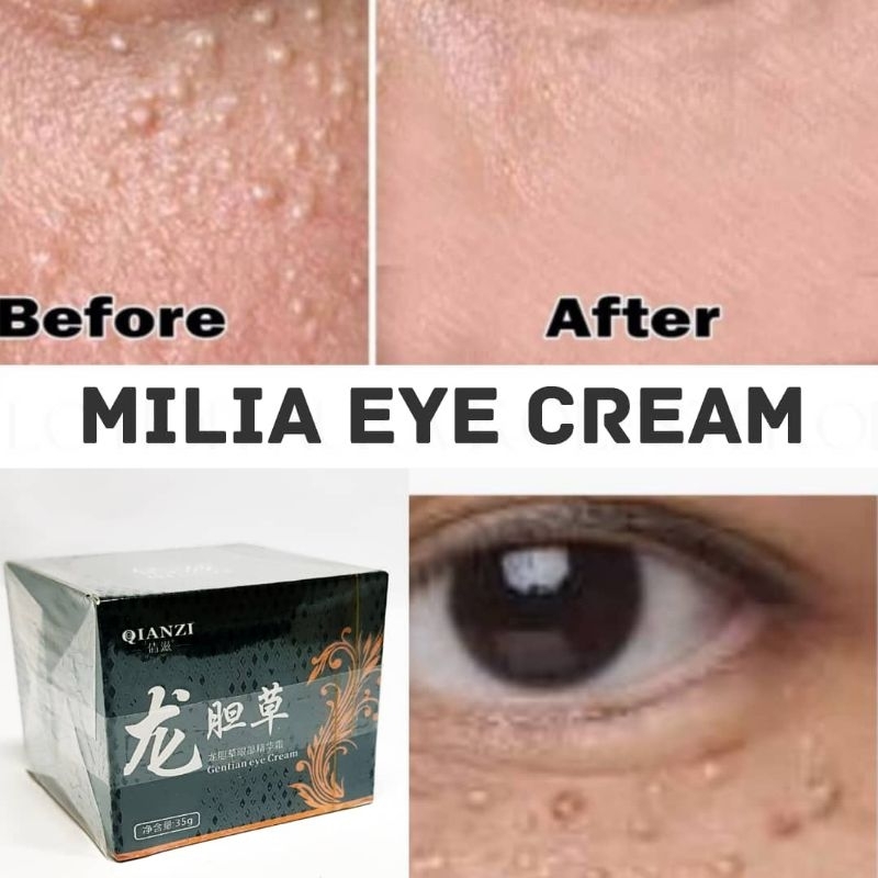 Treatment Milia Eye Cream/ Biji Kolesterol/ Minyak Biji/ Granules ...