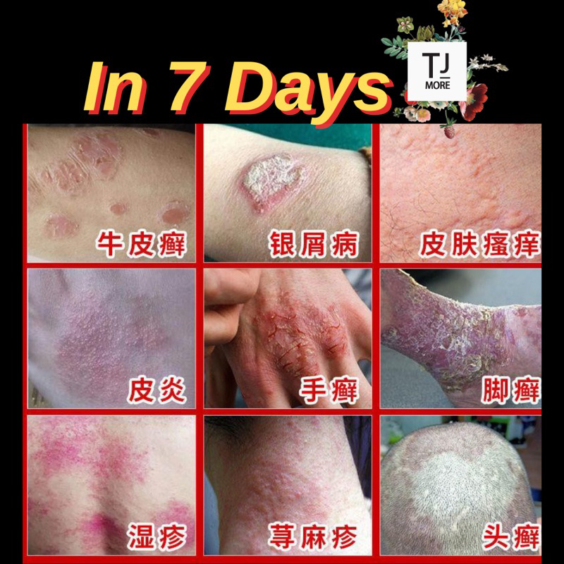 Dandruff Shampoo Herbal Tinea Capitis Bacteriostatic Oily Dry Skin Hand ...