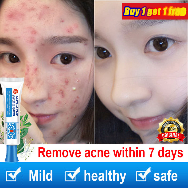 Anti-Acne Cream Acne Treatment Gel Pimple Scars Remover Skin Care ...