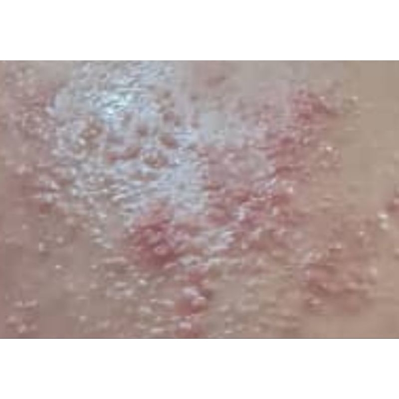 Ubat/Penawar Kayap Alam Nur | Shopee Malaysia