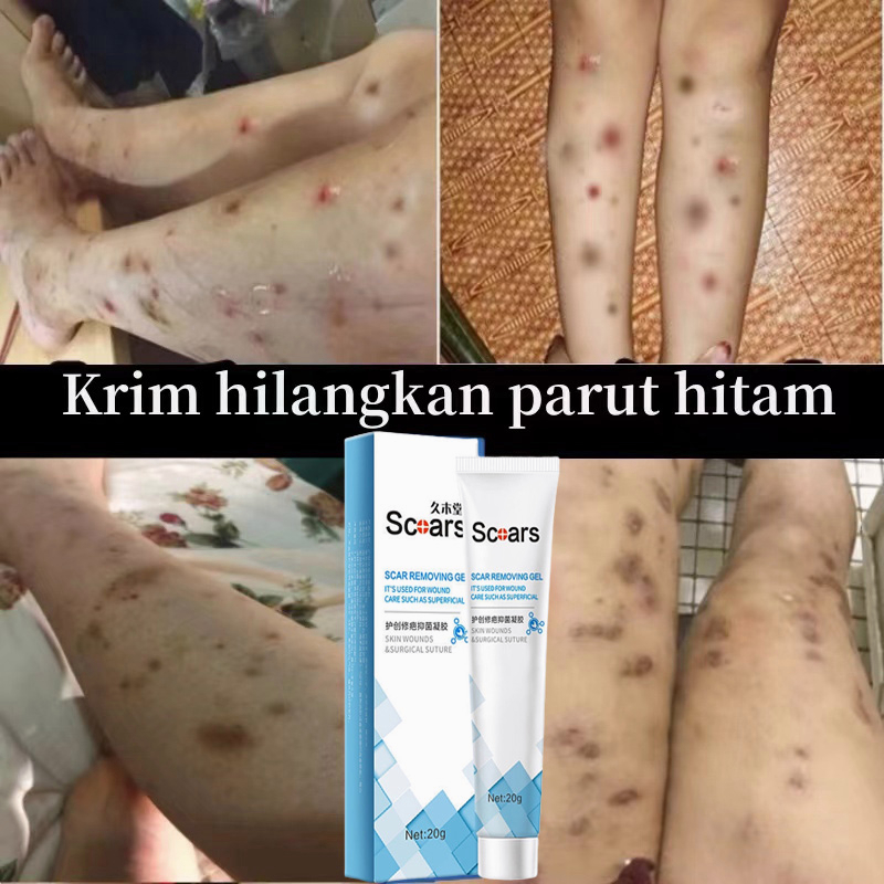 krim parut kaki Krim hilangkan parut Hilangkan parut kaki Parut hitam ...