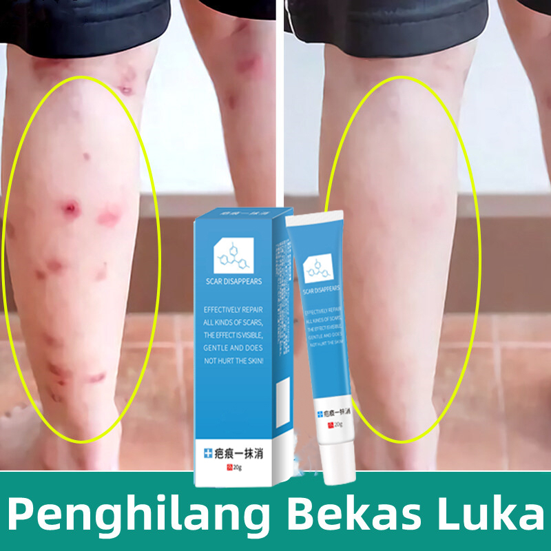 Krim hilangkan parut hitam Hilangkan parut kaki Hilangkan parut kudis parut luka lama mosquito ...