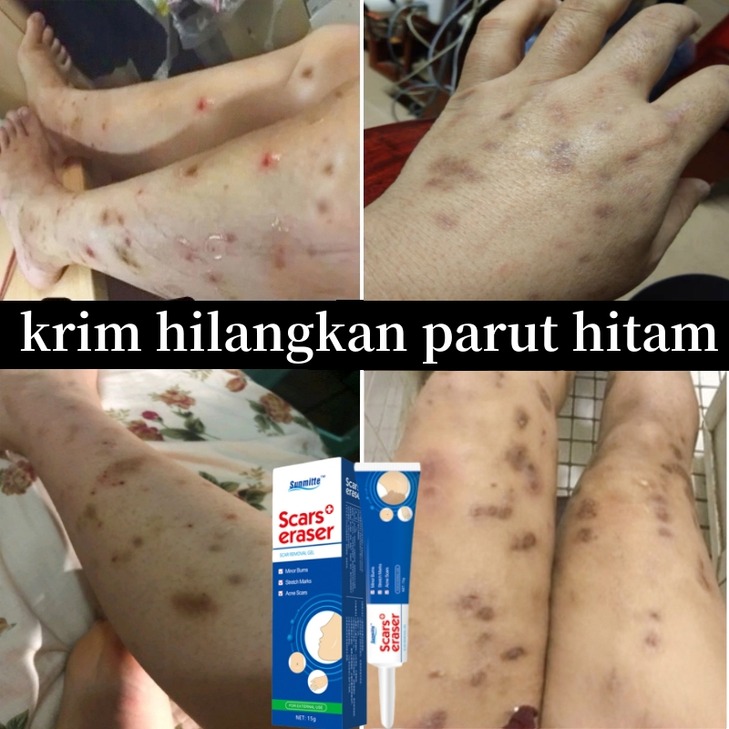 Ubat hilangkan parut Krim hilangkan parut hitam Hilangkan parut kaki ...