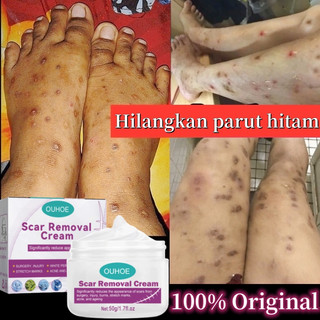 krim hilangkan parut hitam Menghilangkan bekas luka lama Ubat parut ...
