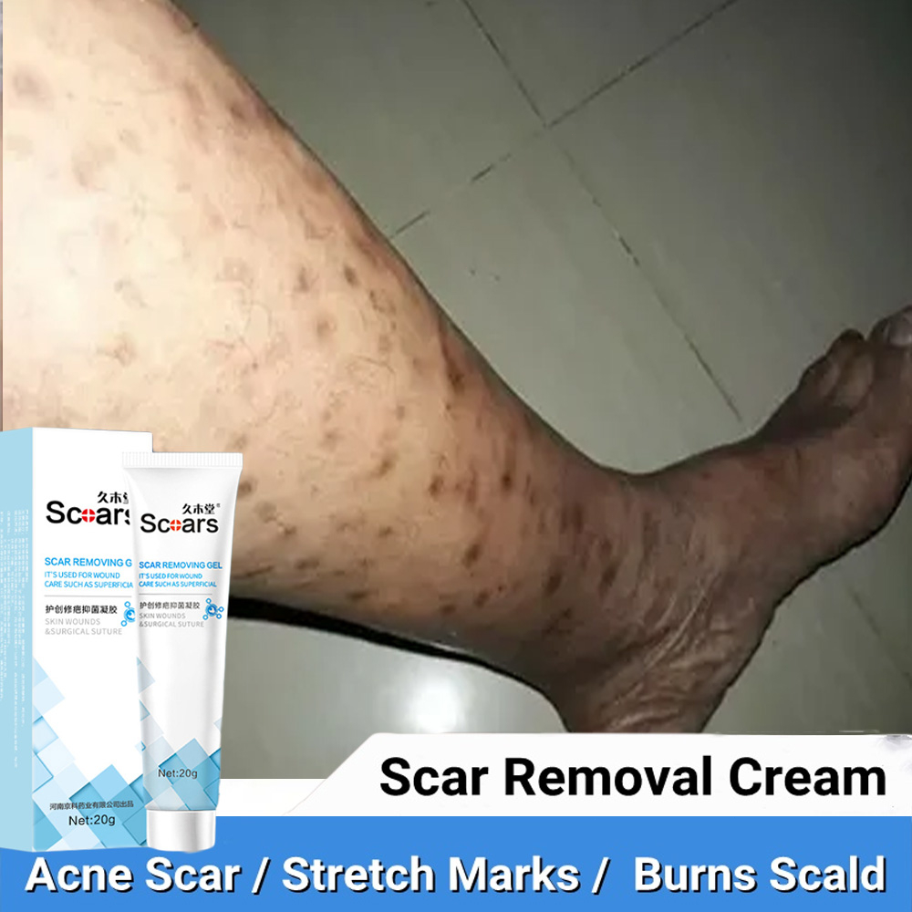 Krim hilangkan parut Hilangkan parut kaki Parut hitam jerawat removal ...
