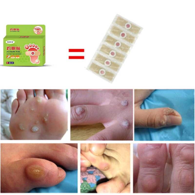 PLASTER MATA IKAN, Corn remover plaster, buang ketuat , warts, kulit ...