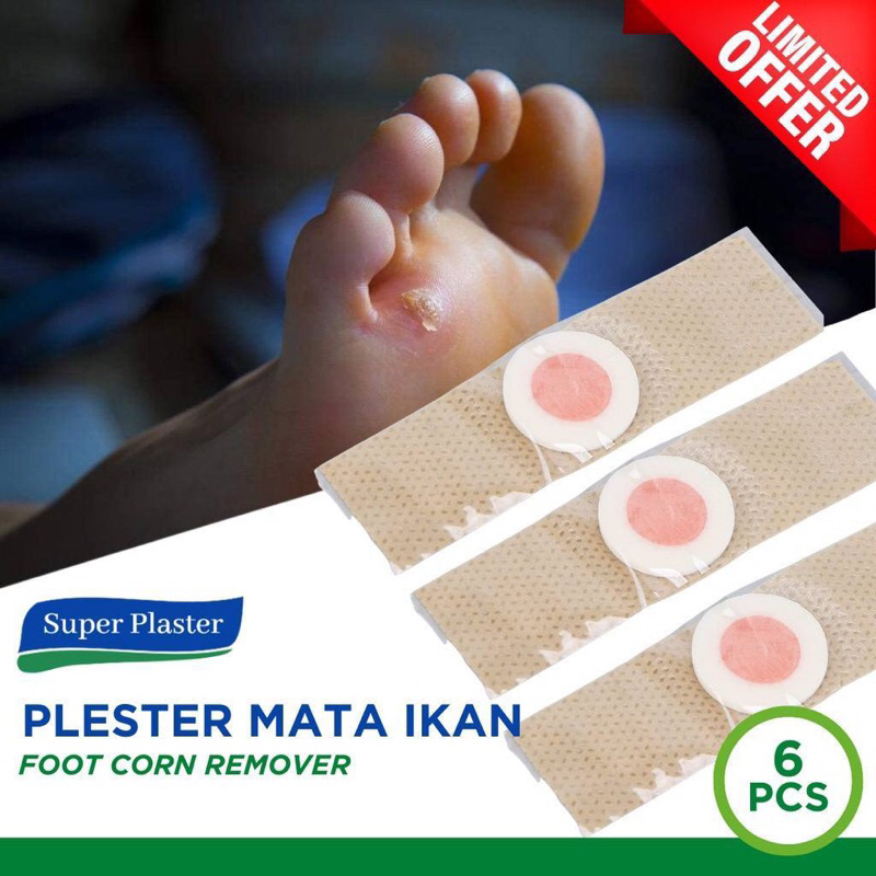 PLASTER MATA IKAN, Corn remover plaster, buang ketuat , warts, kulit ...