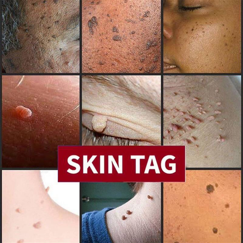 SKIN TAG REMOVAL PATCHES penanggal ketuat kutil skin tag biji kolestrol ...