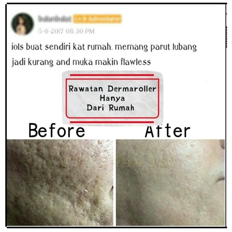 PARUT JERAWAT SET DERMAROLLER SERUM PARUT JERAWAT PARUT BERLUBANG ...