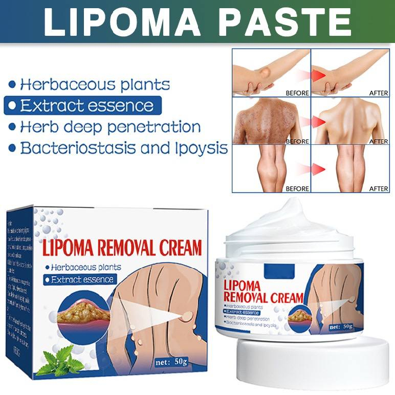 Lipoma Removal Cream Skin Swelling Ointment Original Herbal Pain Relief ...