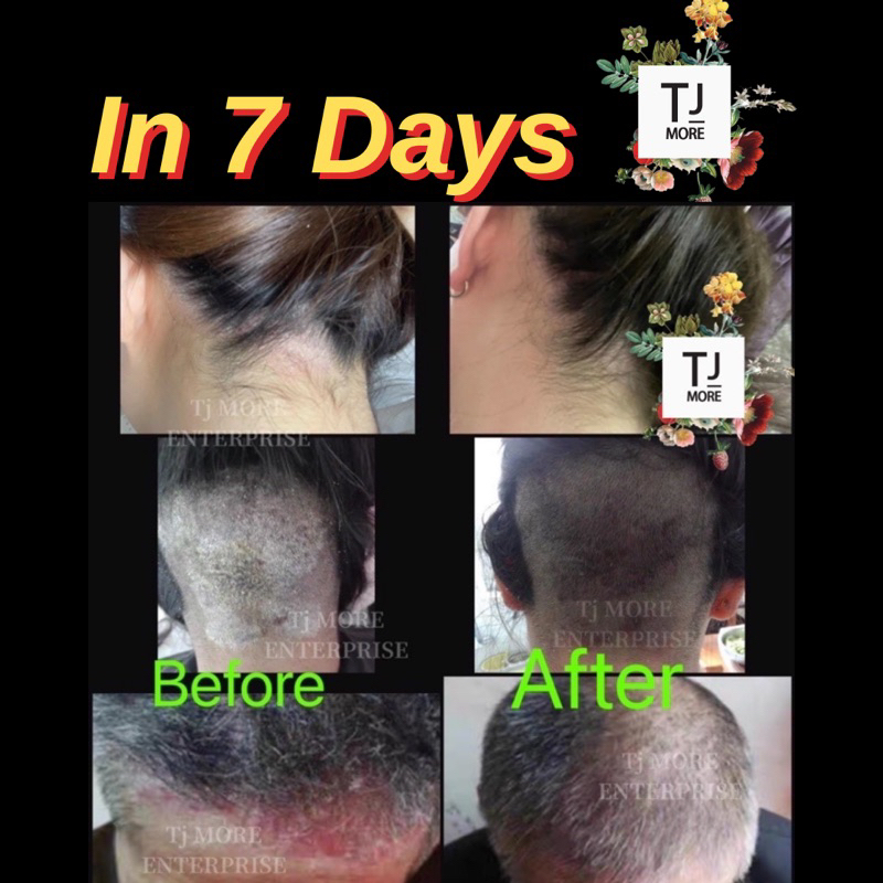 Herbal Dandruff Body Hand Skin Itchy Shampoo Tinea Capitis ...