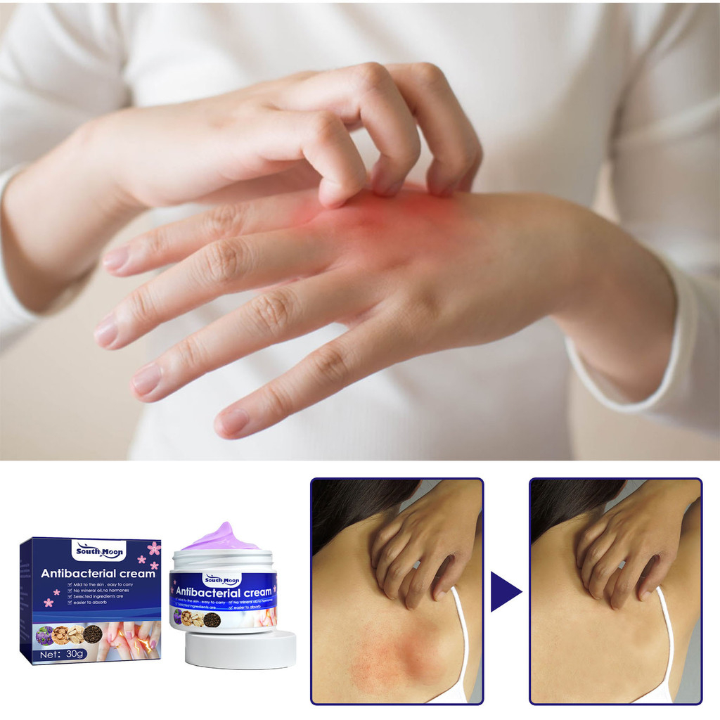 krim gatal kulit ubat gatal kulit Antibacterial Cream Eczema Itchy Itchy Peeling Dermatitis ...