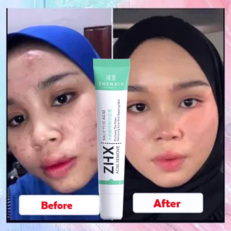 ubat jerawat acne cream repair acne pimple hilangkan parut jerawat ...
