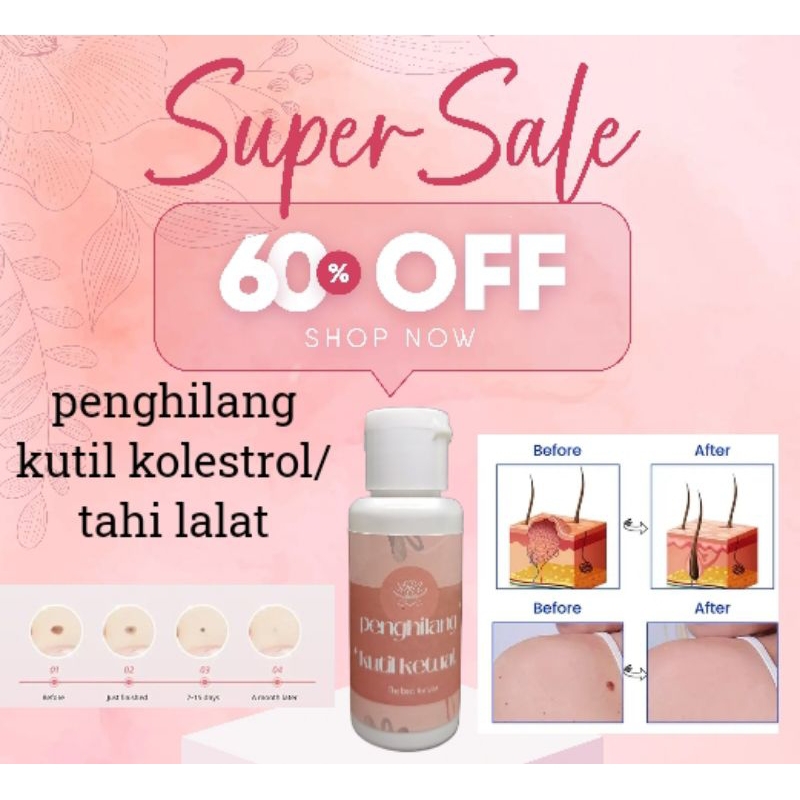 penghilang ketuat tahi lalat kutil kolestrol hingga ke akar. | Shopee Malaysia