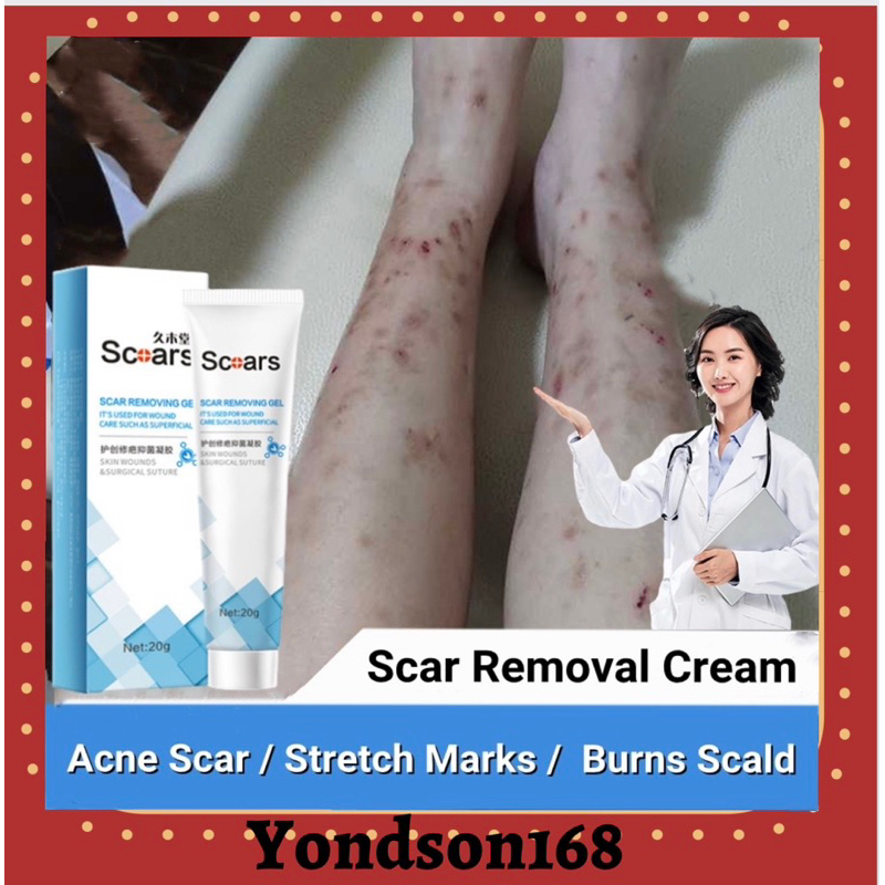 Krim hilangkan parut Hilangkan Parut kaki Krim hilangkan parut hitam ...