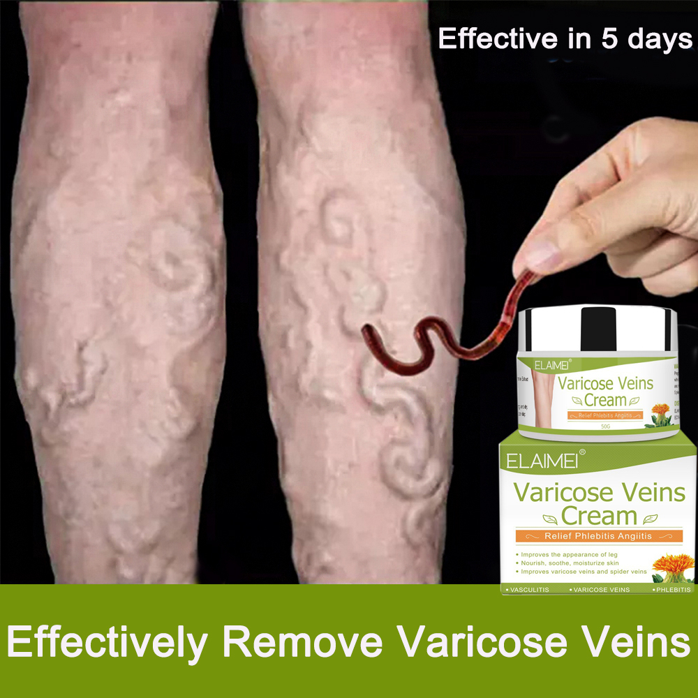 Varicose Vein Treatment Cream Vasculitis Phlebitis Spider Ointment ...