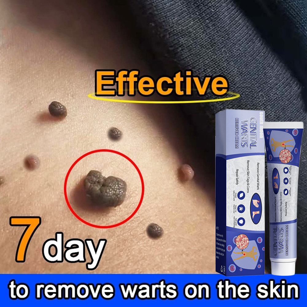 Ubat buang kutil ketuat tahi lalat biji kolestrol Skin Tag Mole Ketuat ...