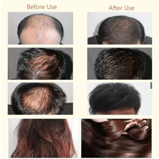 💯Original Hair Tonic Hair Growth Serum Ubat Rambut Gugur lelaki Anti ...