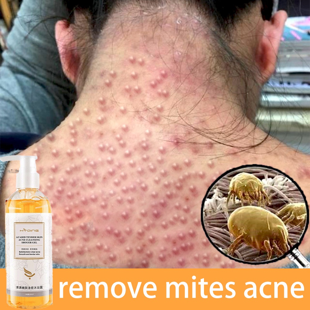 Acne Mites Anti Itch Eczema Kulit Gatal Shower Gel Amino Acid Whitening ...