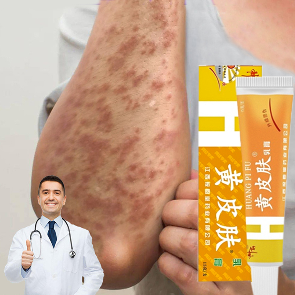 eczema cream krim psoriasis cream ubat gatal ketuat krim eczema ...