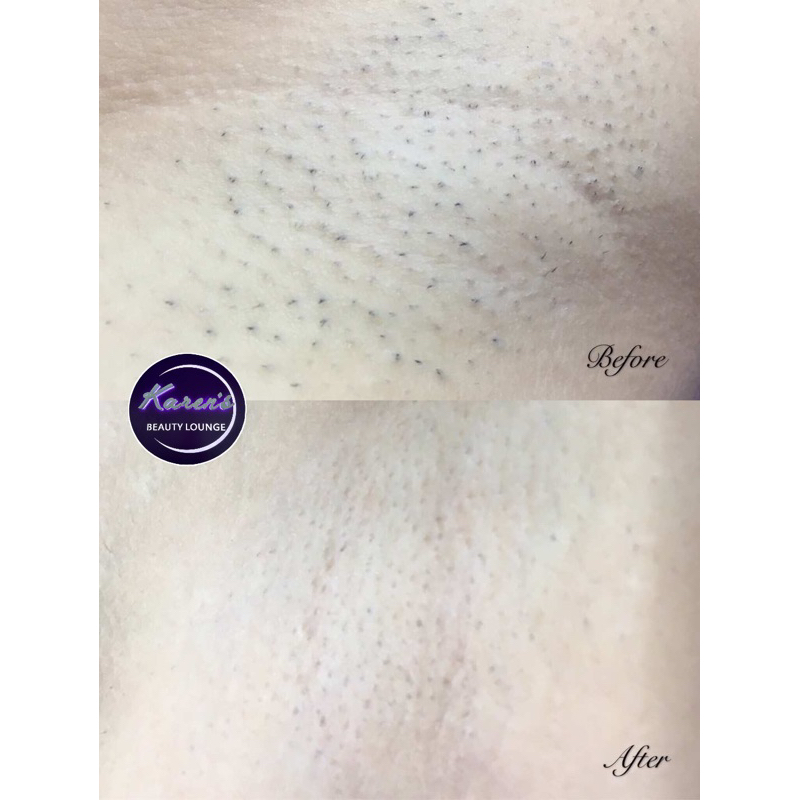 Armpit IPL Hair Removal | Shopee Malaysia