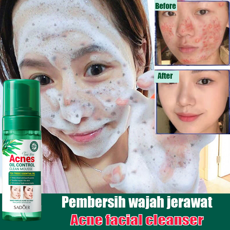 jerawat facial mites acne cleanser Acne mites remove Oil control ...