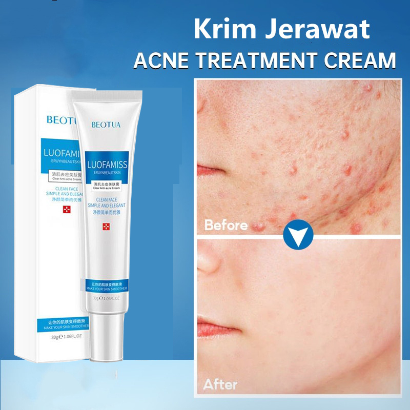 Acne removing cream Repair Acne Marks And Acne Pits To Fade Acne Scars ...
