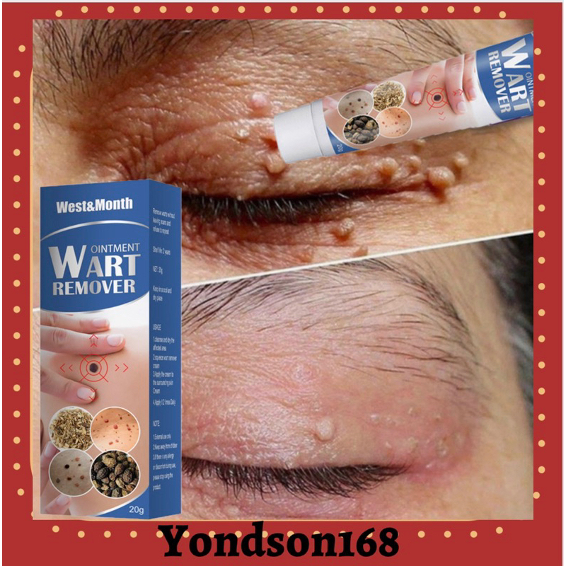 Krim ketuat 克疣膏 Ubat buang kutil ketuat tahi lalat biji kolestrol Mole ...