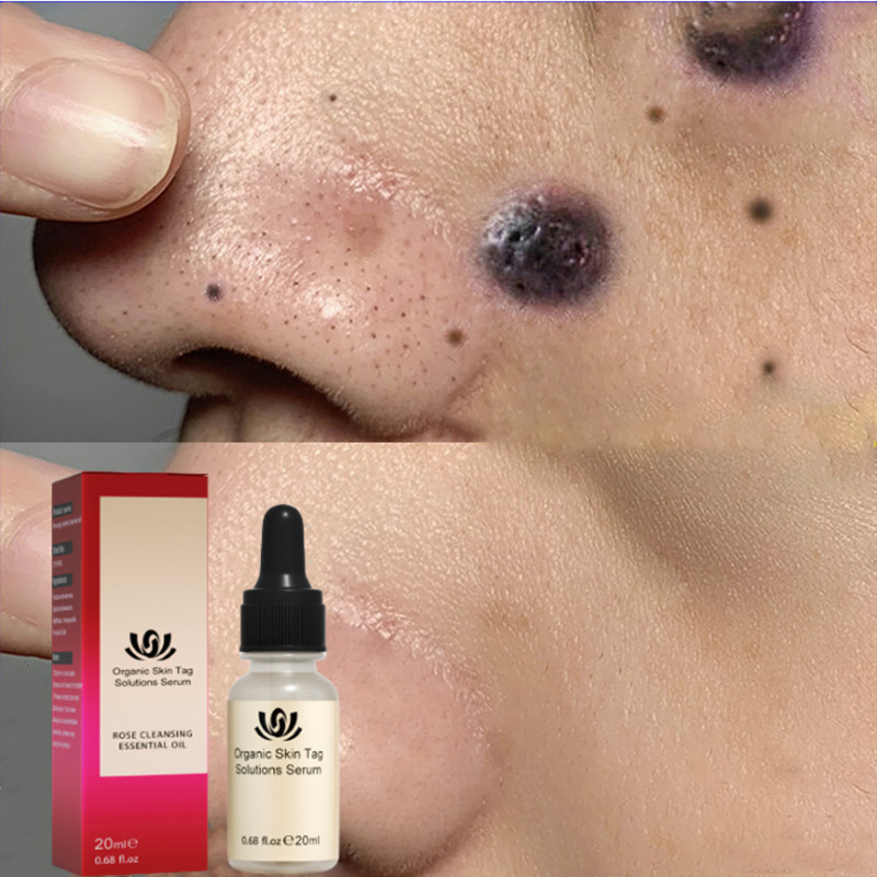 Ubat Kutil Tahi Lalat Ketuat Dan Biji Kolesterol Skin Tag Remover Mole ...