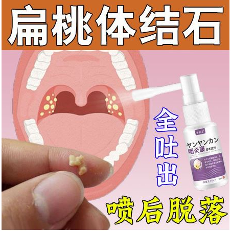 pharyngitis spray tonsil stones removal spray bad breath spray anti ...