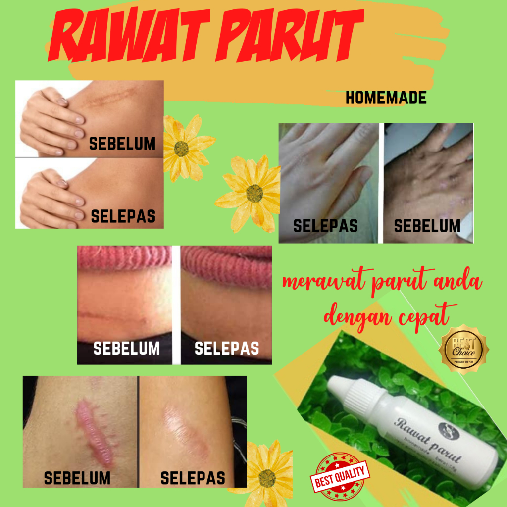 krim rawat parut,menghilangkan parut,parut lama dan parut baru,bintik ...
