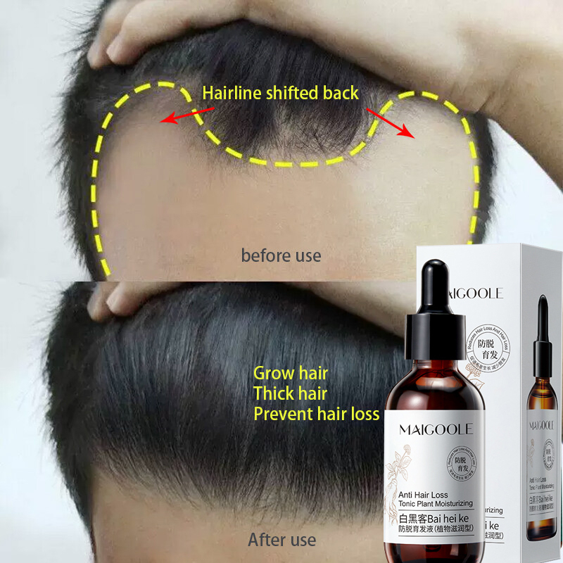 💯Original Hair Tonic Hair Growth Serum Ubat Rambut Gugur lelaki Anti ...