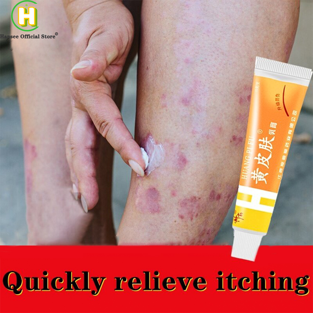 Psoriasis Cream Eczema Cream antibacterial cream/ezema/ubat psoriasis ...