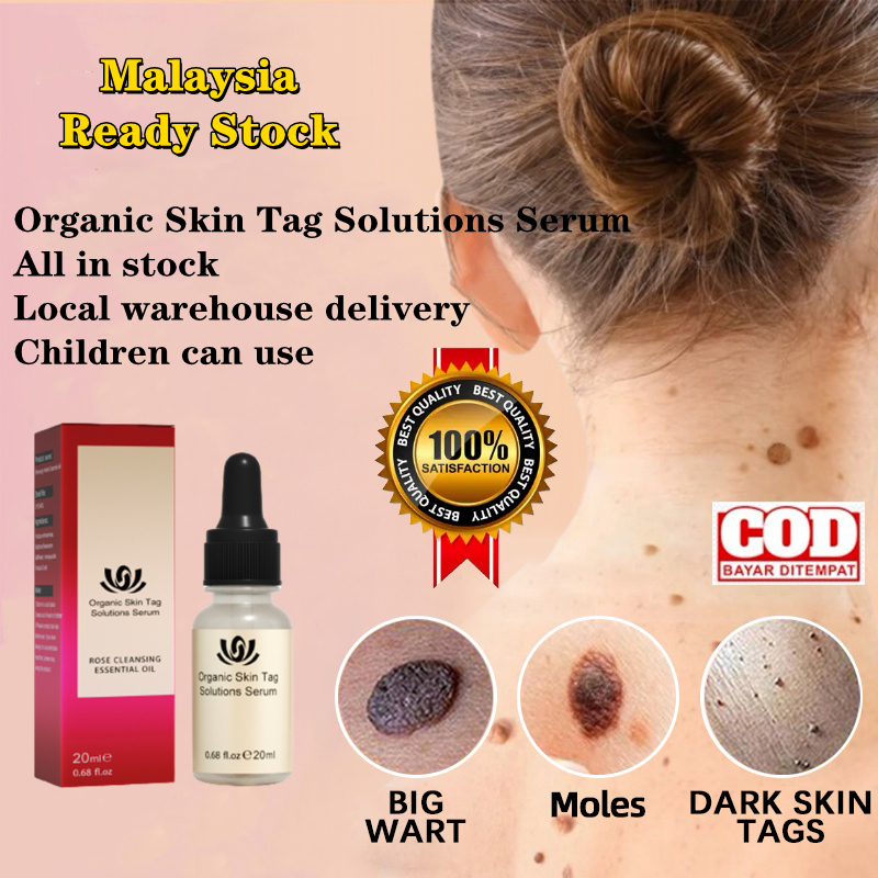 buang tahi lalat Mole Remover Serum Skin tag Remover Wart Mole Lighten ...