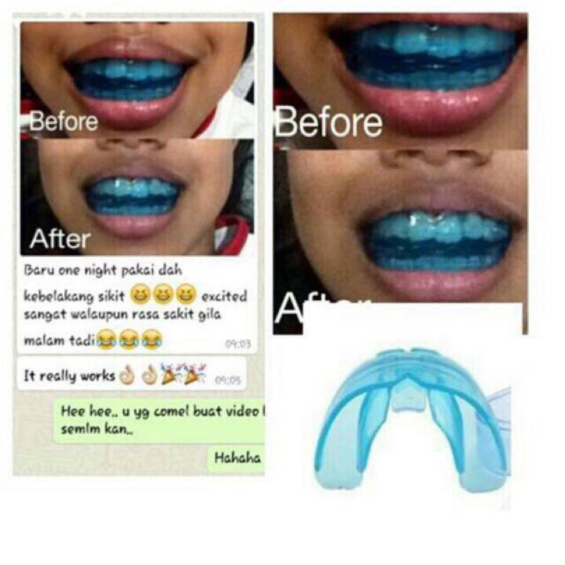 TEETH TRAINER RATAKAN GIGI JONGANG RAPATKAN GIGI JARANG BETULKAN ...