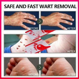 penampal ketuat ubat ketuat Wart Remover Pads Corn Remover 鸡眼贴 6 pcs ...