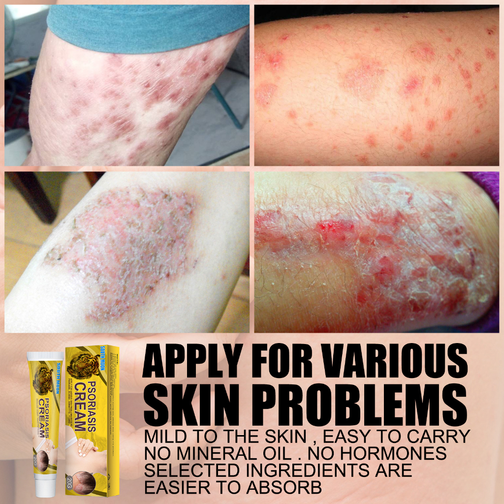 Psoriasis Cream Eczema Dermatitis Itching Ubat Sapu Ekzema Gatal Kurap ...