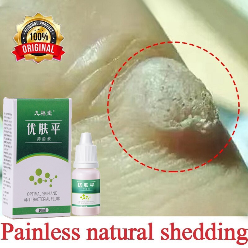 Ubat Ketuat Warts Removal Cream Ubat Kutil 10g Quick Removal Of Warts ...