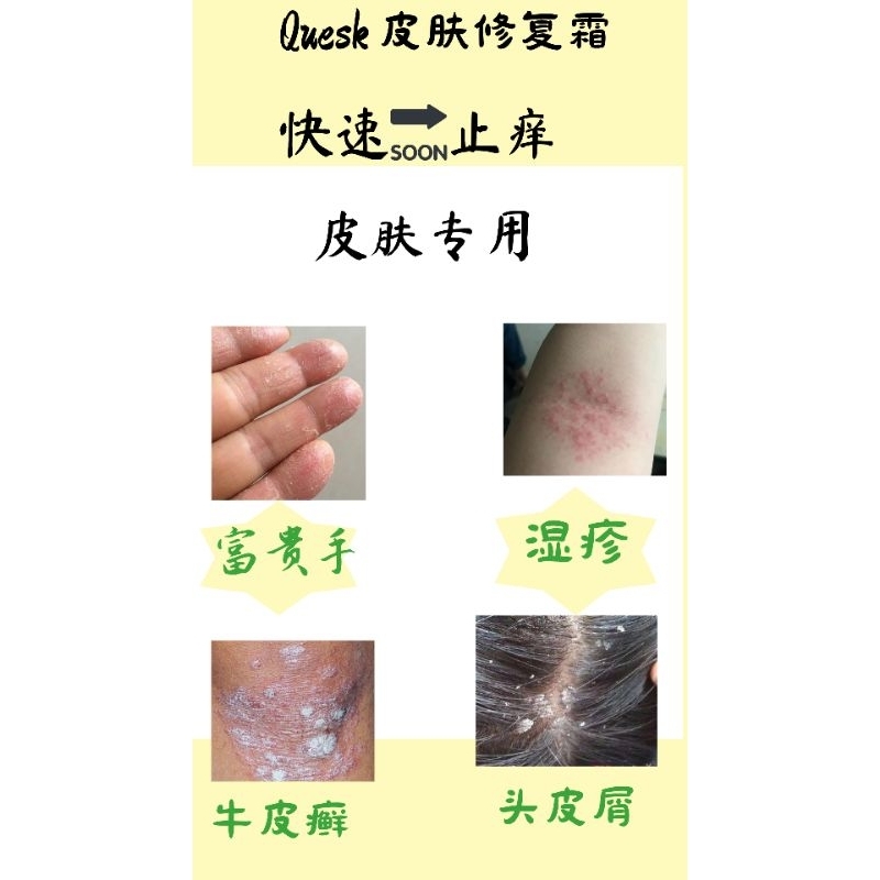 Quesk skin Repair Cream，Queak修复霜~止藓膏,牛皮癣，富贵手，汗斑，湿疹Eczema , anti-moss ...